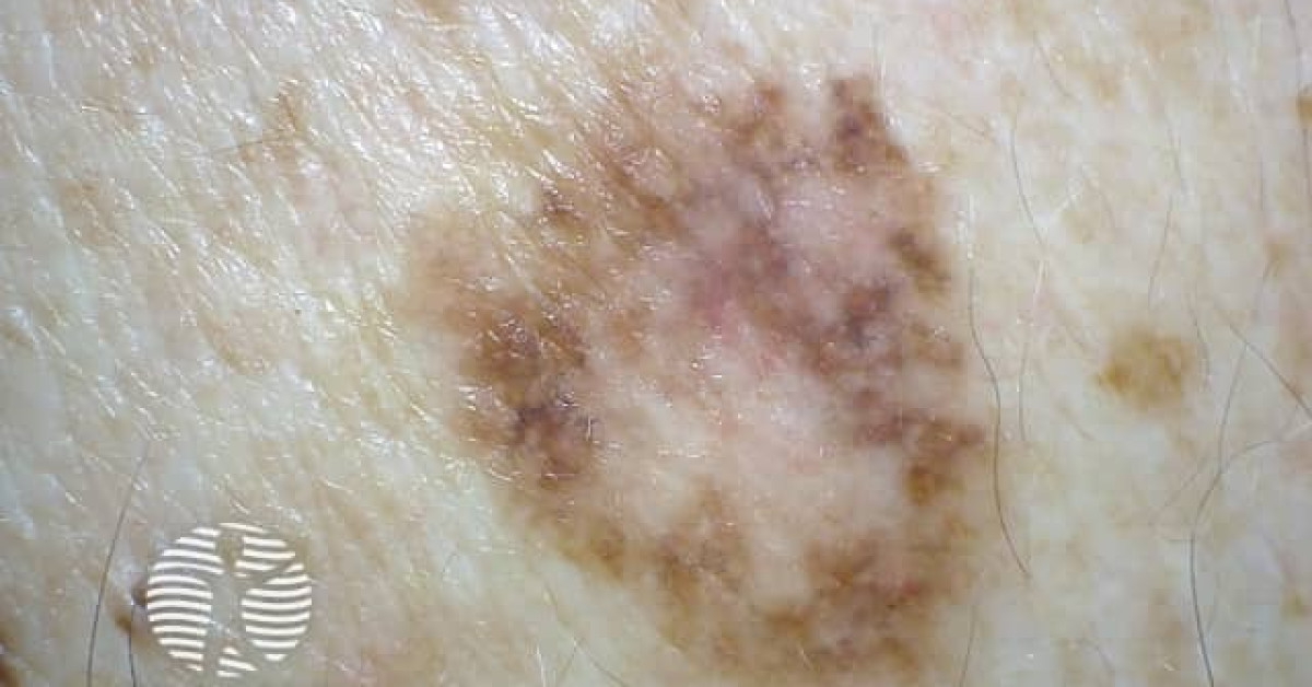 Lentiginous melanoma image