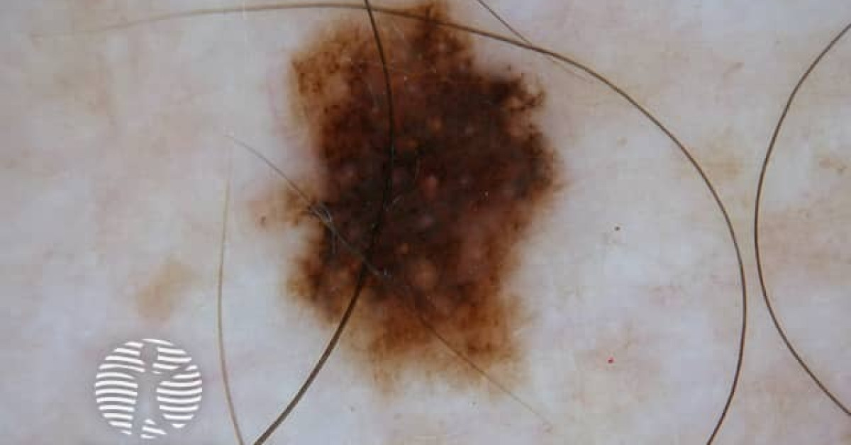 Lentigo simplex image