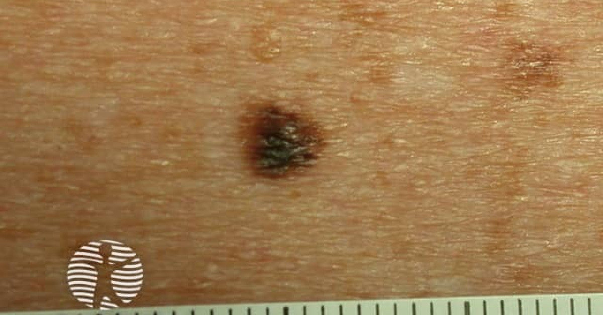 Lentigo simplex image