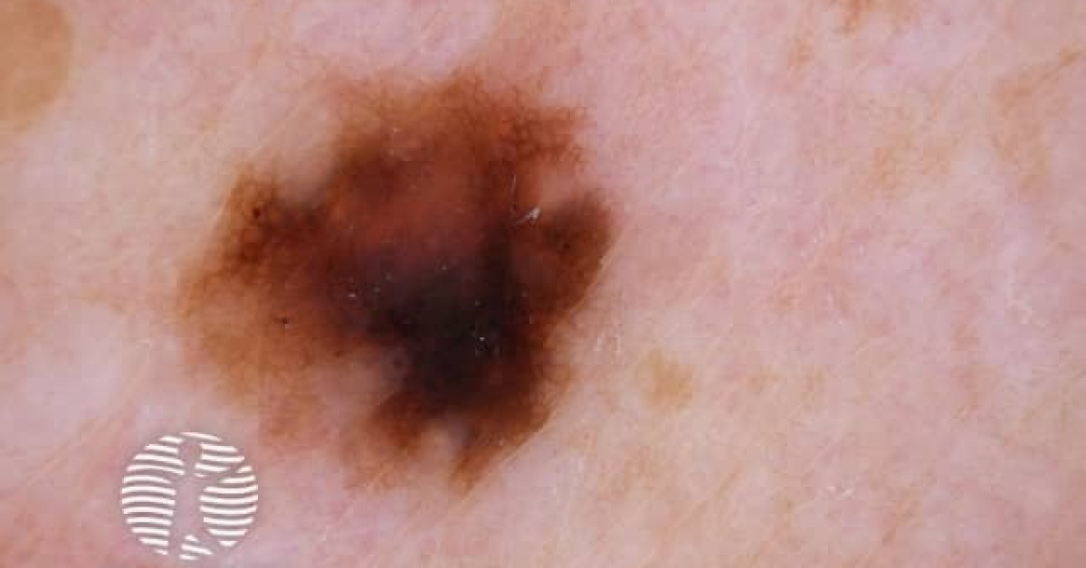 Lentigo simplex image