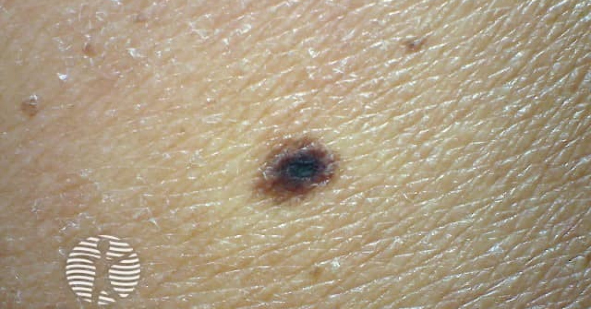 Lentigo simplex image