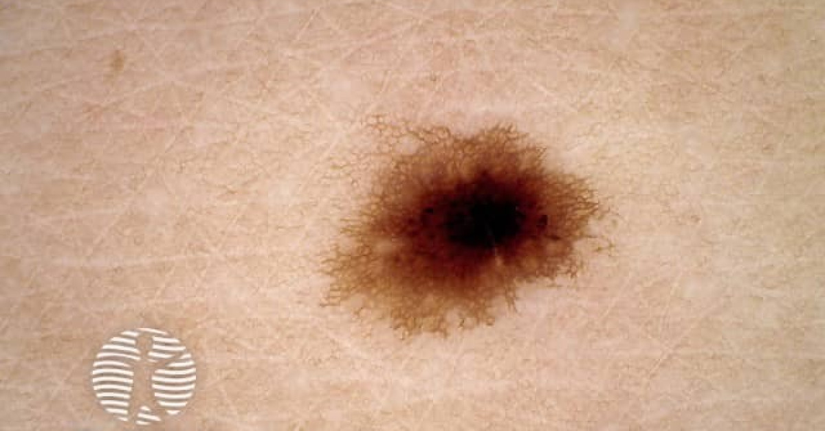 Lentigo simplex image