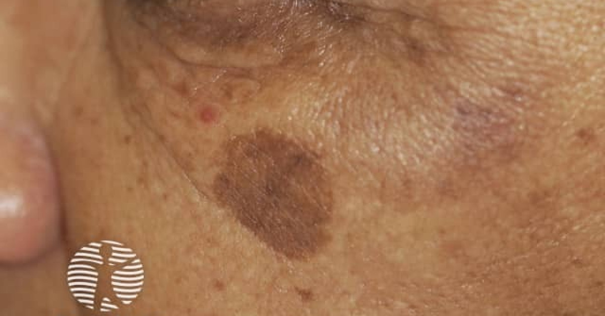 DermNet® - Solar lentigo image