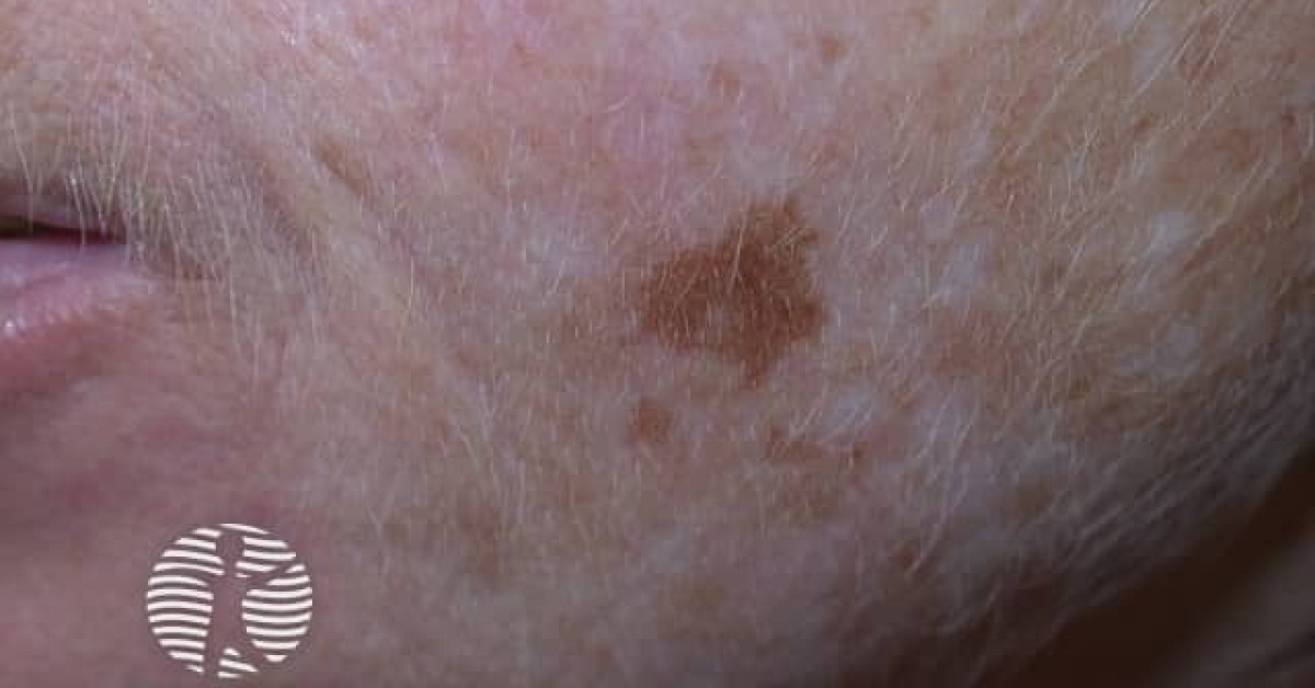 Solar lentigo image