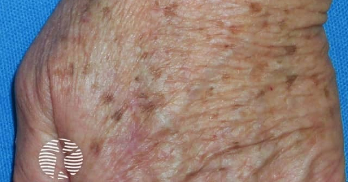 Solar lentigo image