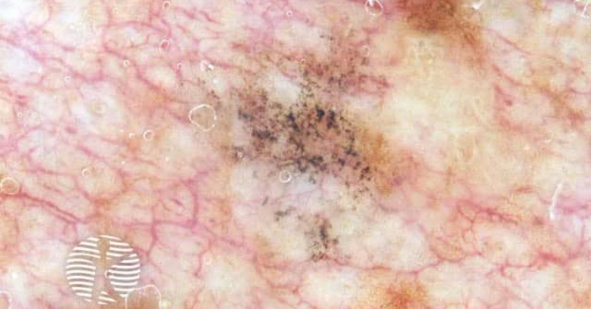 Lichenoid keratosis image