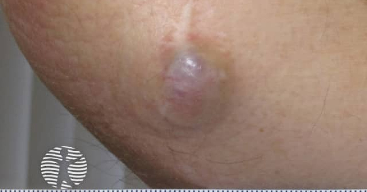 Merkel cell carcinoma image