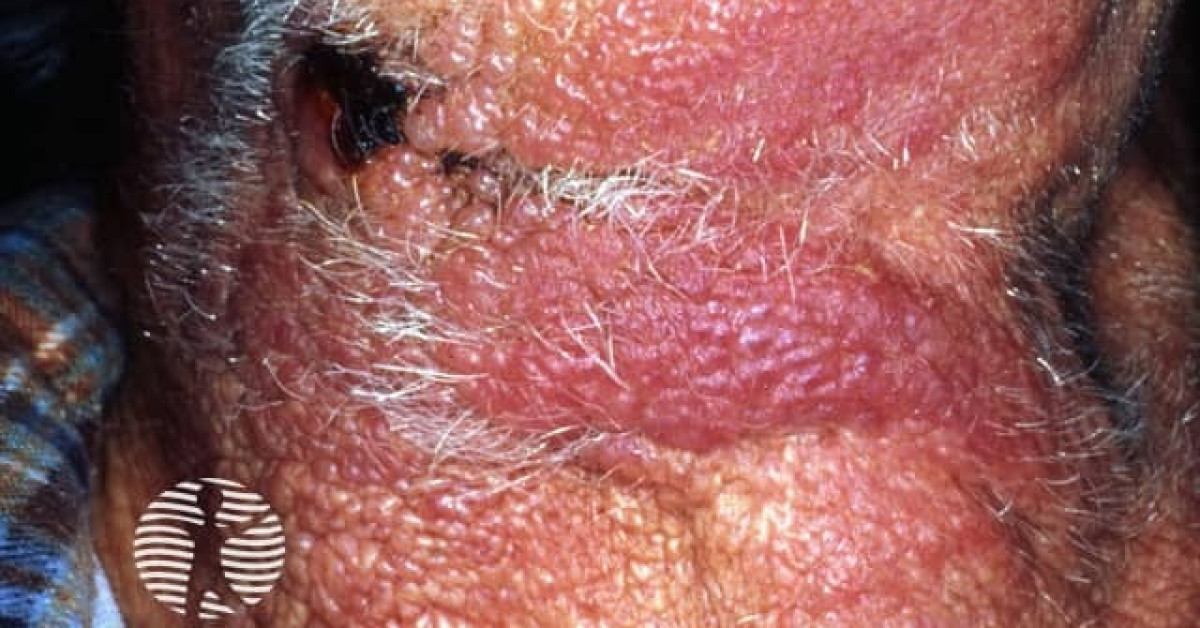 Cutaneous metastasis image