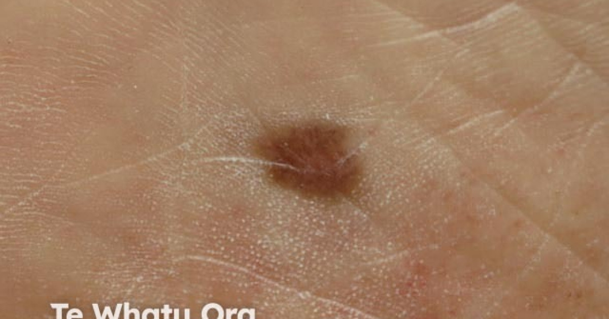 Moles image