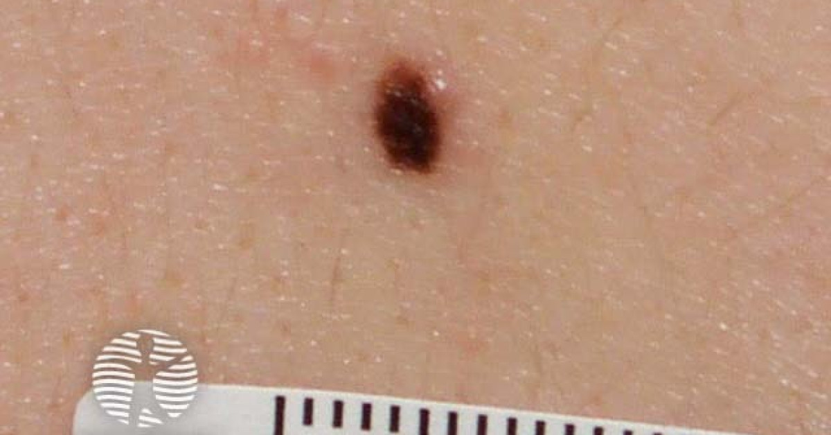 DermNet® - Moles image