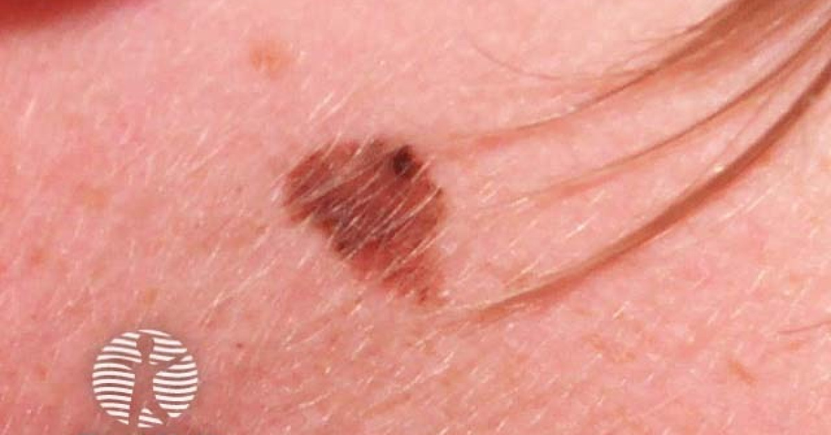 DermNet® - Moles image