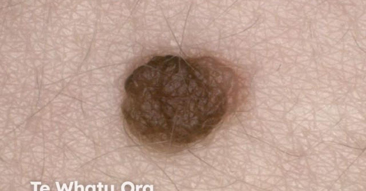 Moles image