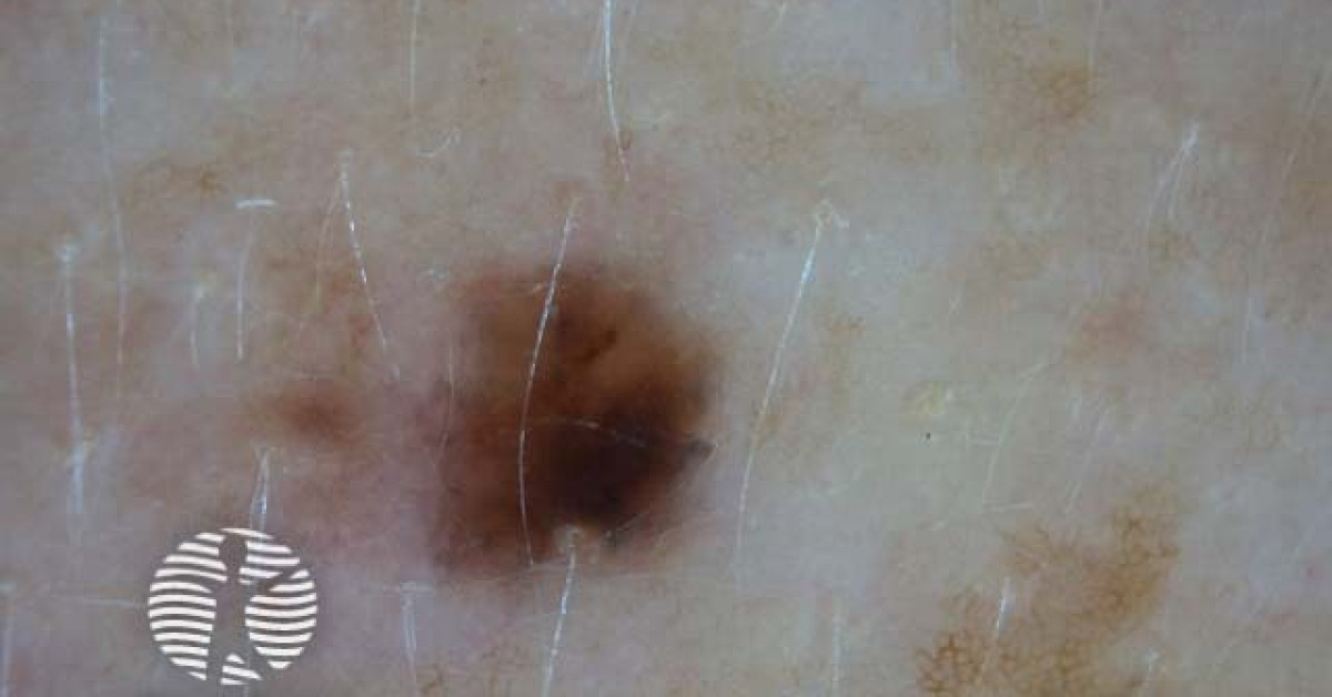 Moles image