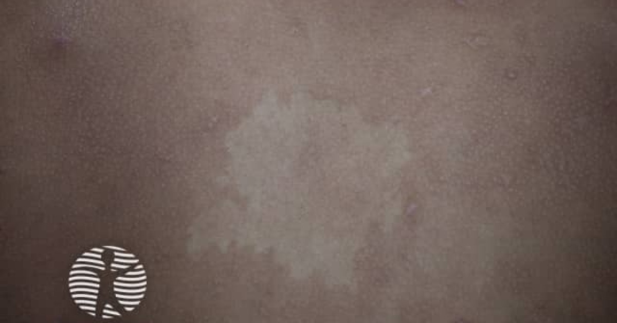 Achromic naevus image