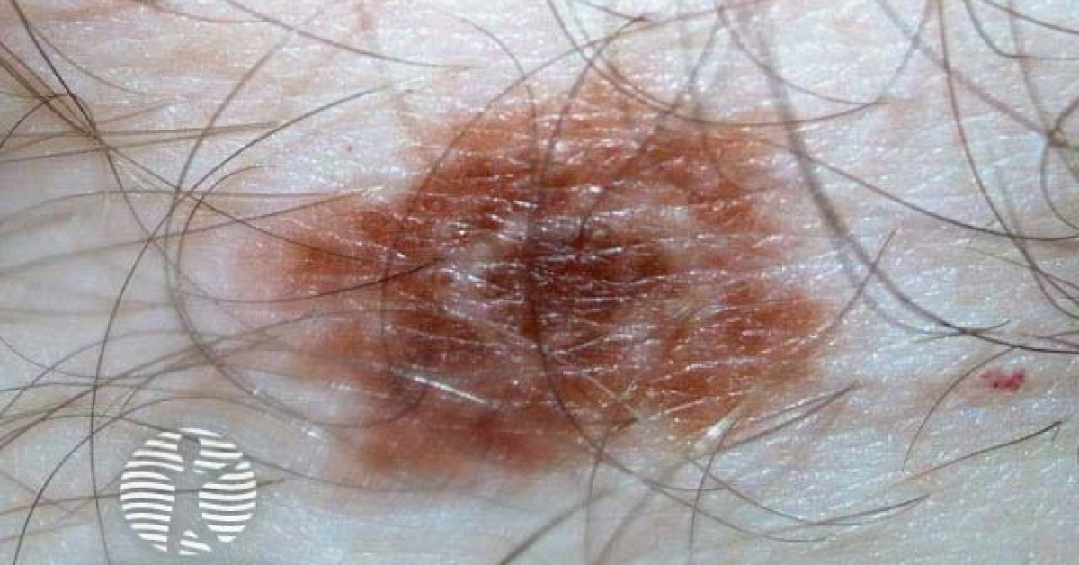 Cockade naevus image