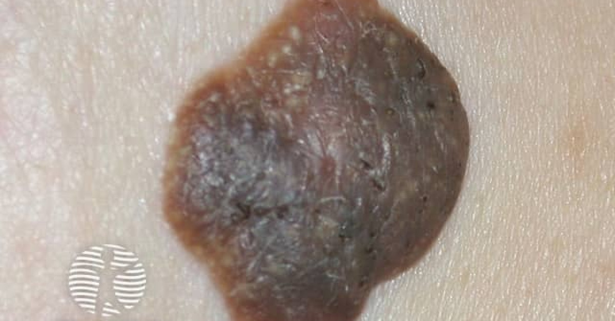 Pigmented seborrhoeic keratosis image