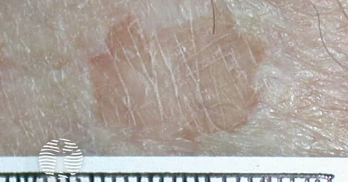 Pigmented solar lentigo image