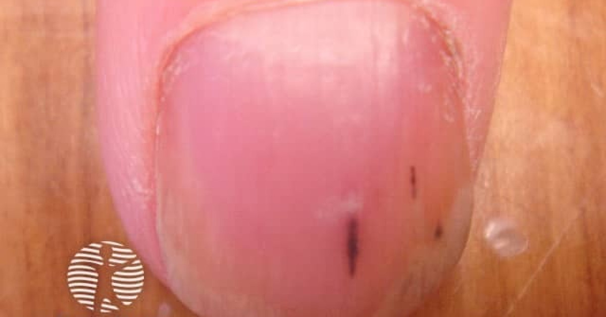 Pigmented splinter haemorrhage image