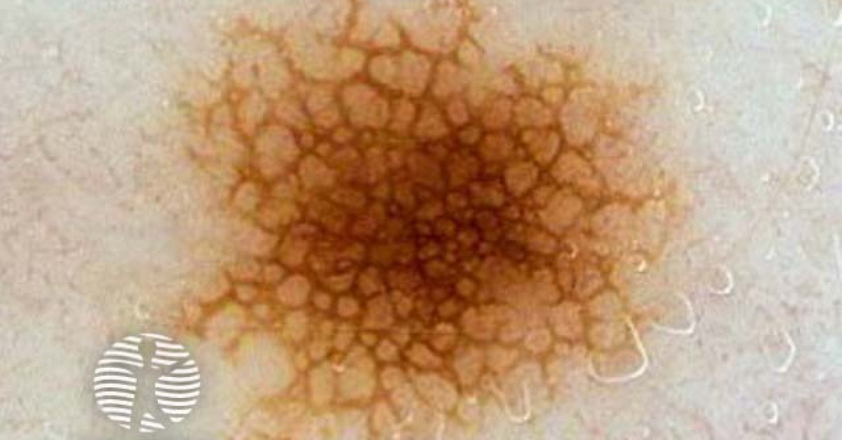 Dermoscopy: reticular naevus image