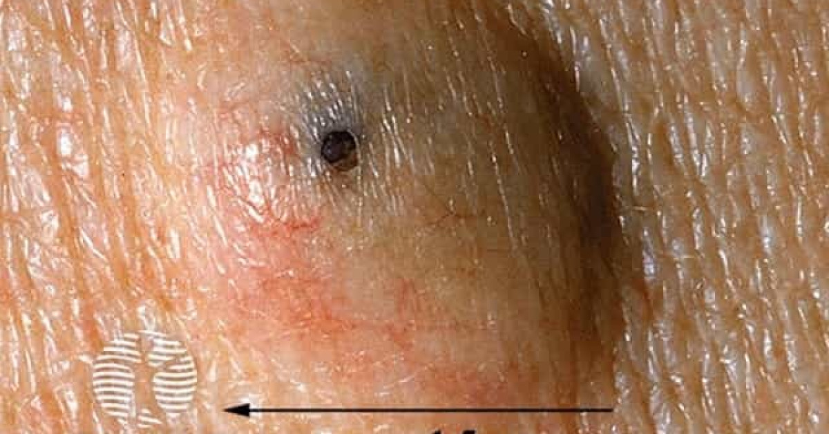Cyst image