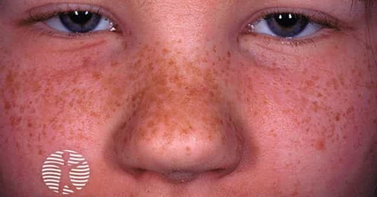 Freckles image