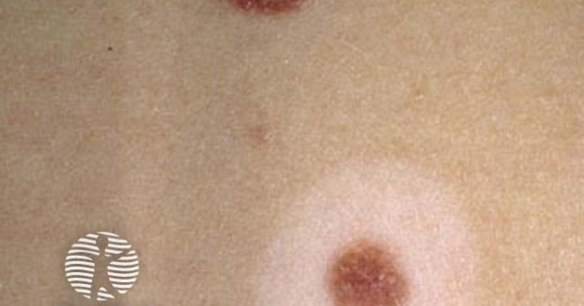 Halo mole image