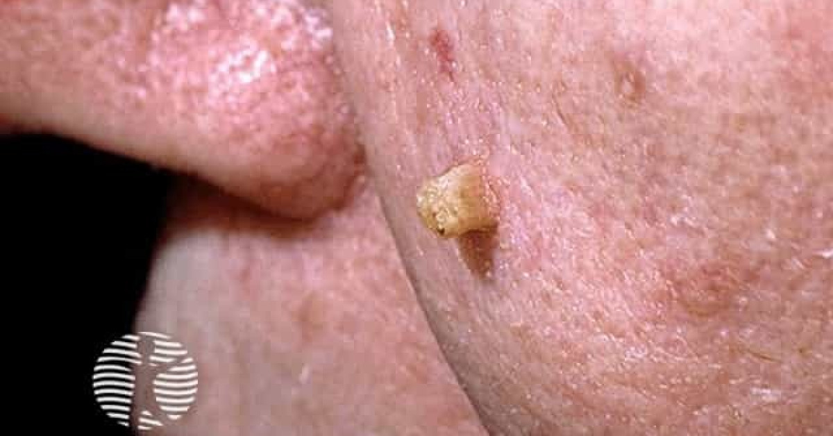 Cutaneous horn image