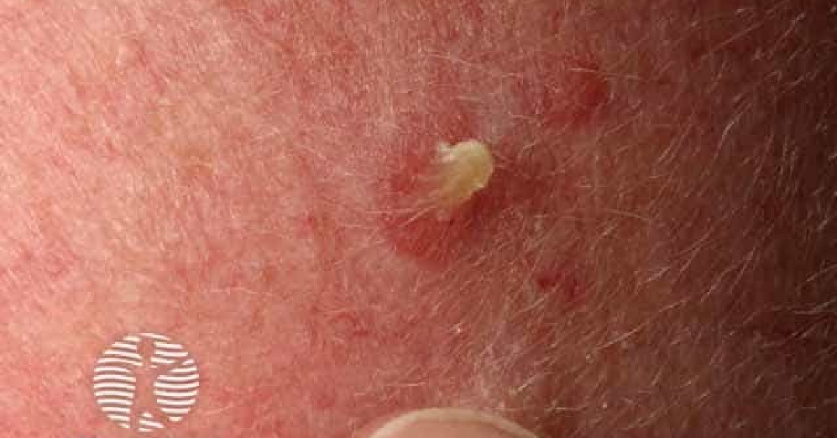 Cutaneous horn image