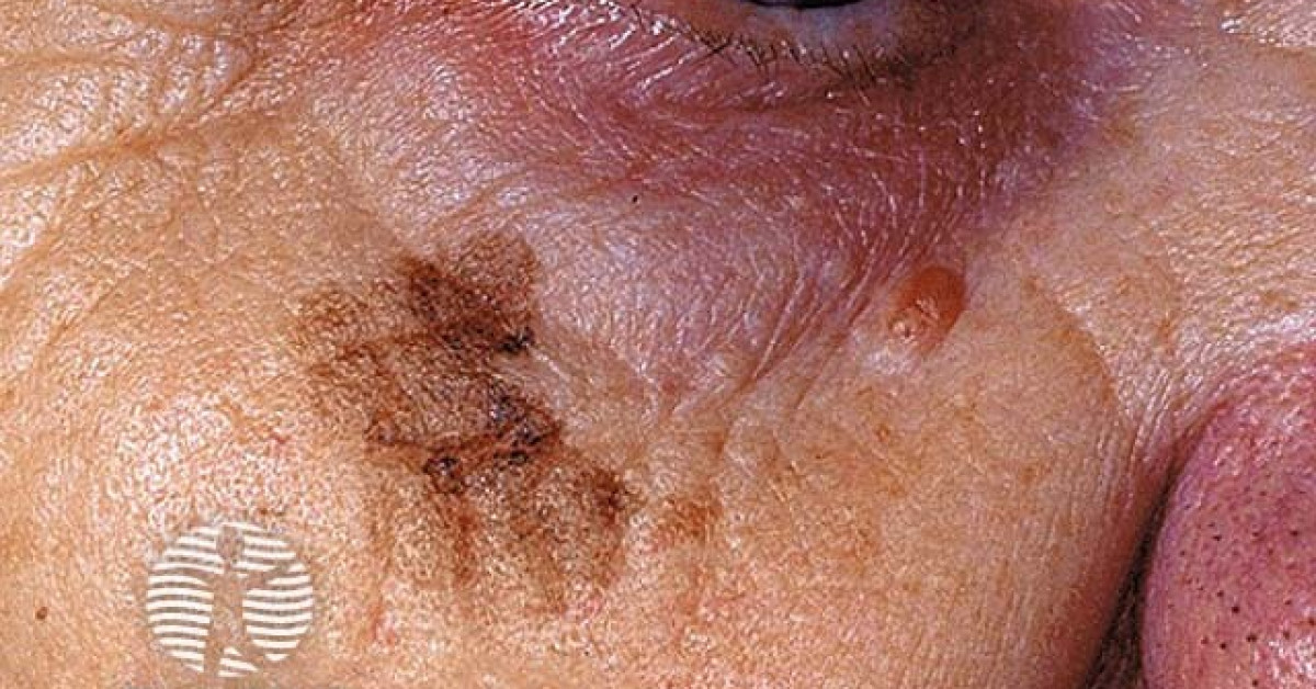 Solar lentigo image
