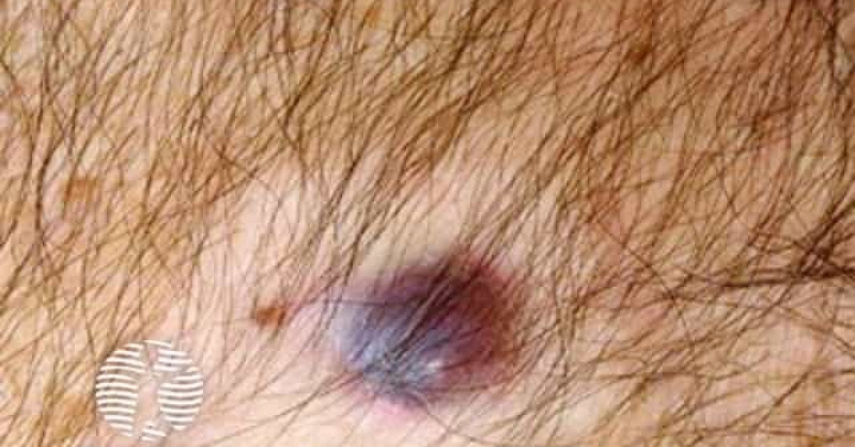 Cutaneous metastasis image