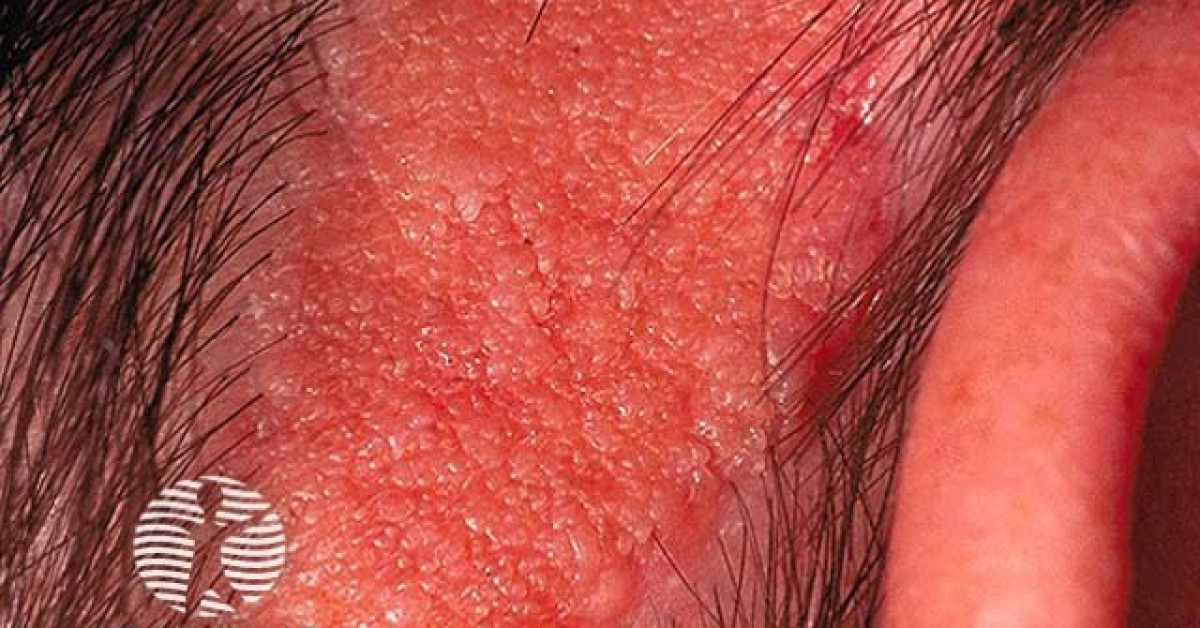 Sebaceous naevus image
