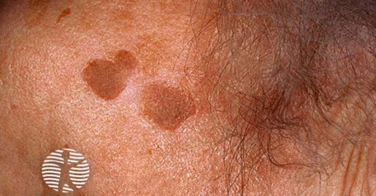 Seborrhoeic keratosis image