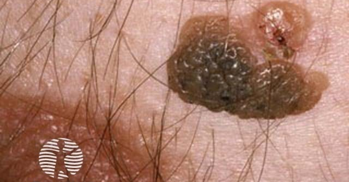 Seborrhoeic keratosis image