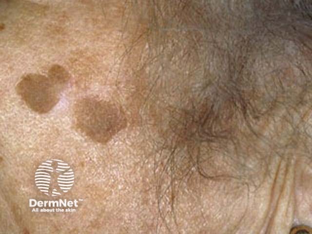 Seborrhoeic Keratoses Images Seborrhoeic Keratoses Images