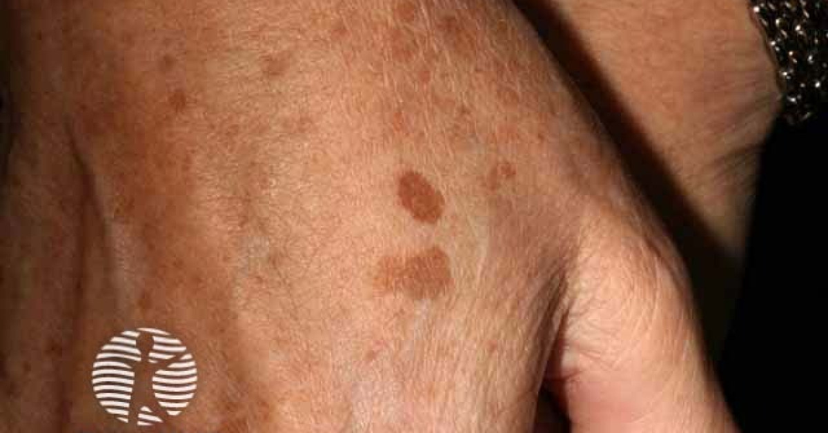 DermNet® - Solar lentigo image