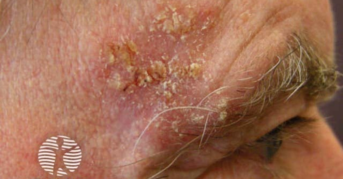 Squamous cell carcinoma on the face image