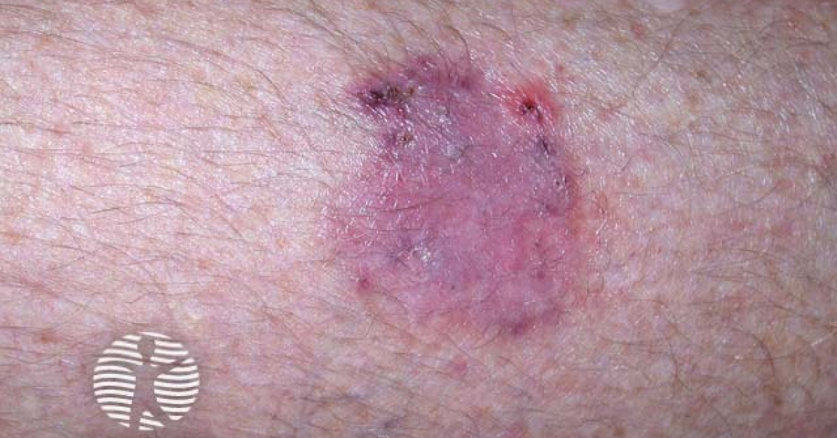 Intraepidermal carcinoma image