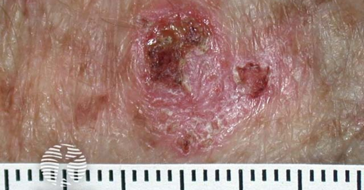Intraepidermal carcinoma image