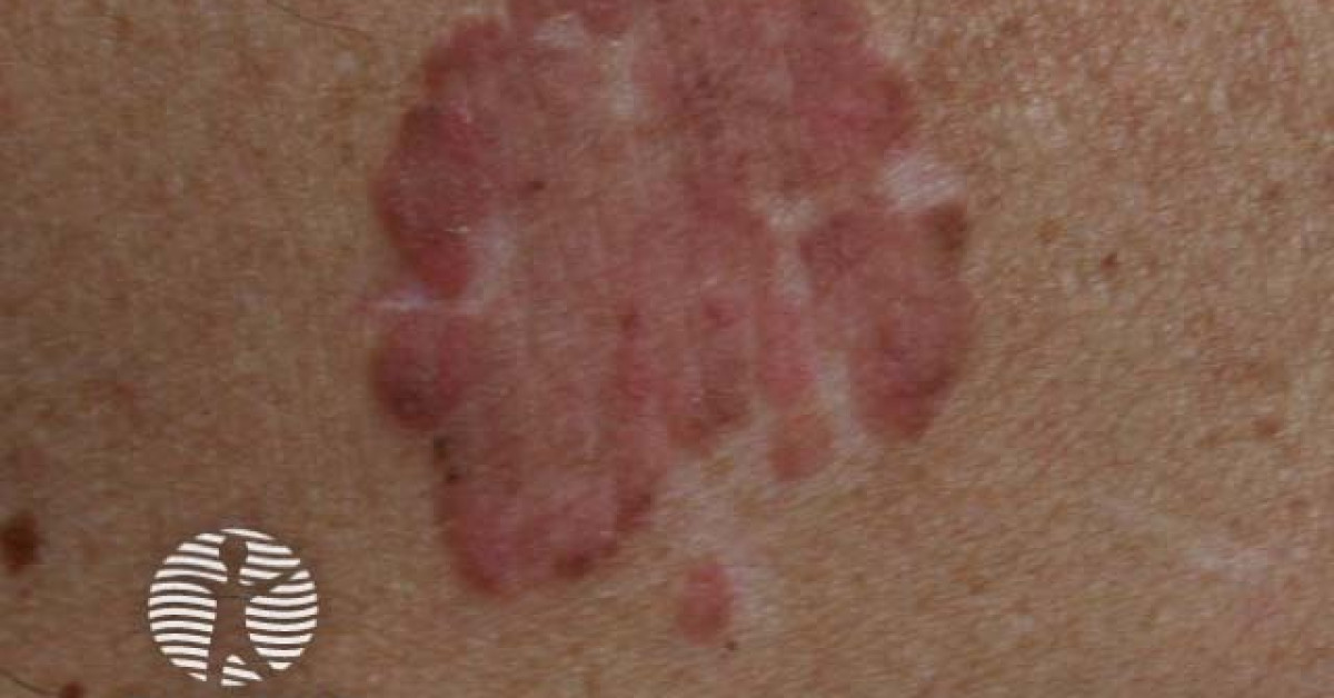 Intraepidermal carcinoma image
