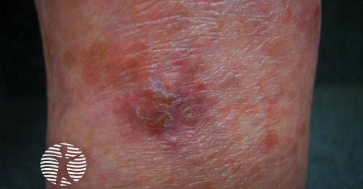 Intraepidermal carcinoma image