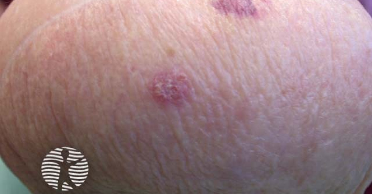 Intraepidermal carcinoma image