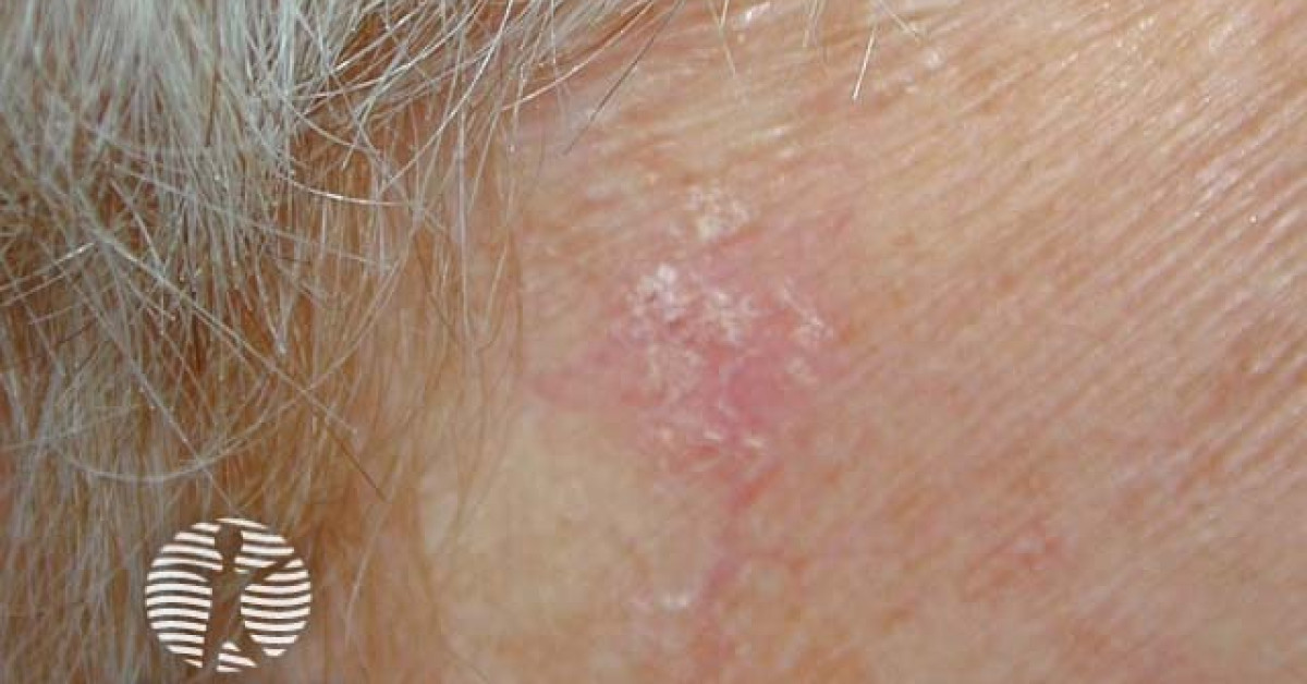 Intraepidermal carcinoma image