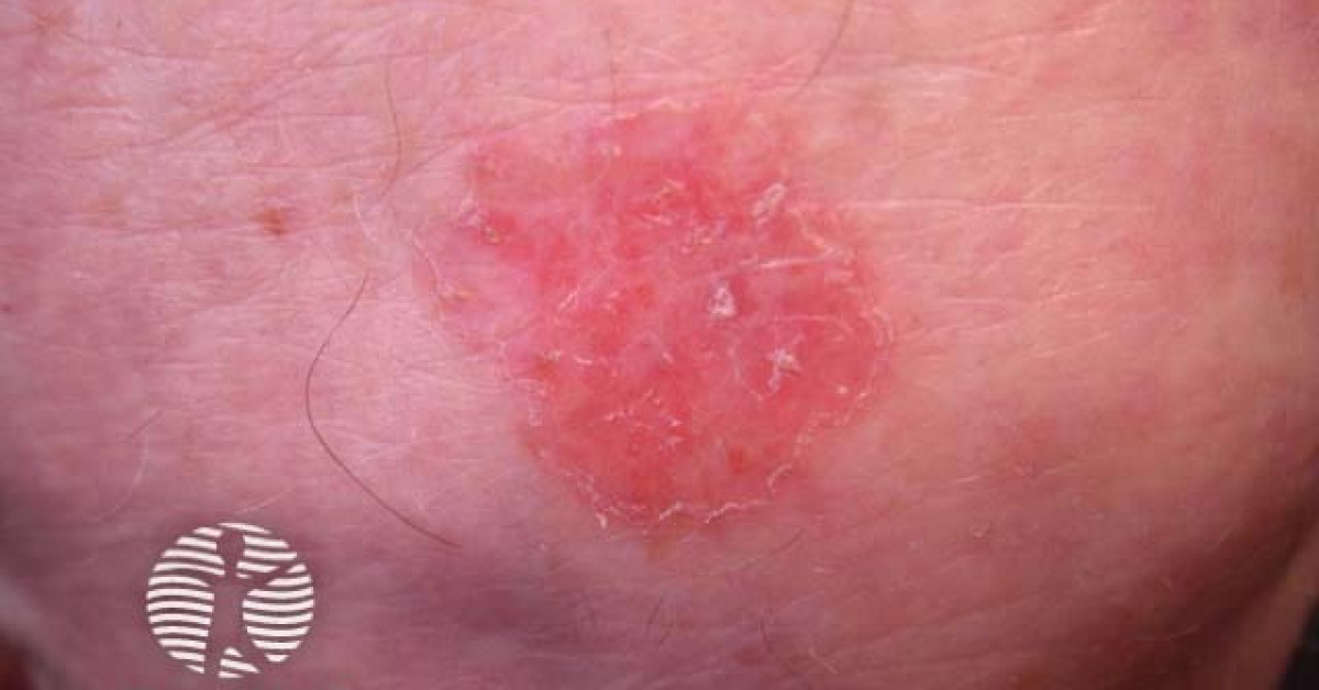 Intraepidermal carcinoma image