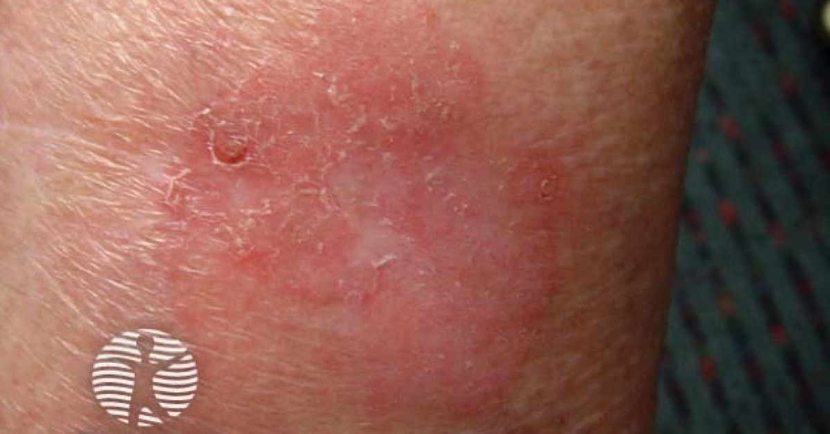 Intraepidermal carcinoma image