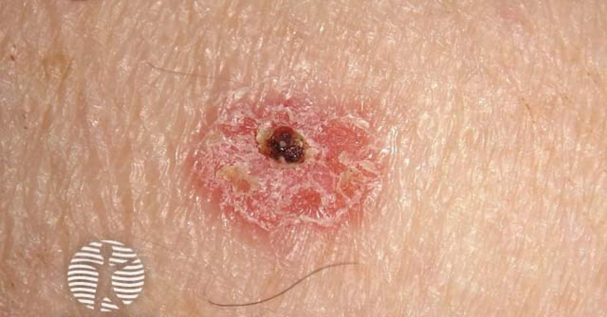 Intraepidermal carcinoma image