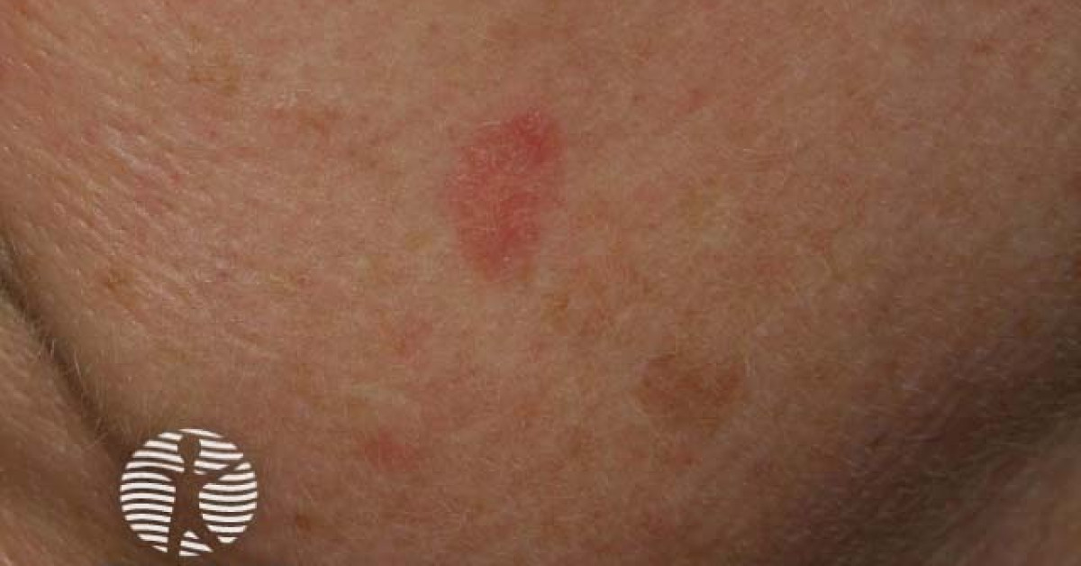 Intraepidermal carcinoma image