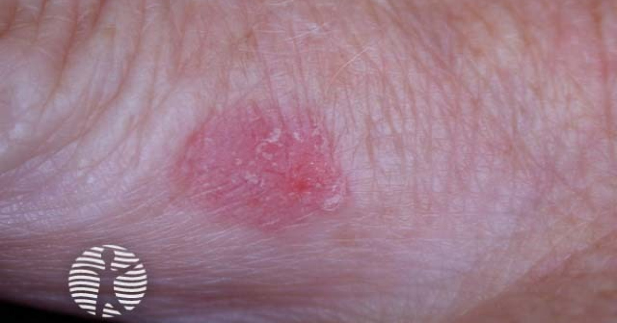 Intraepidermal carcinoma image