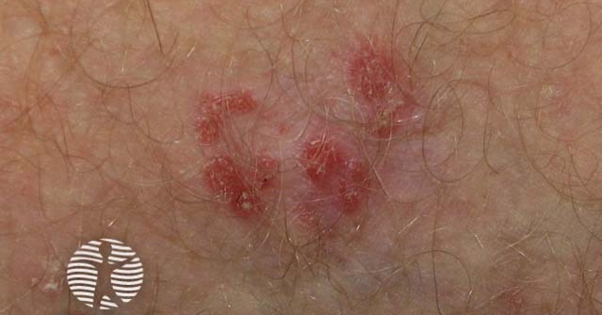 Intraepidermal carcinoma image