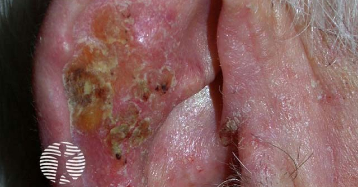 Intraepidermal carcinoma image