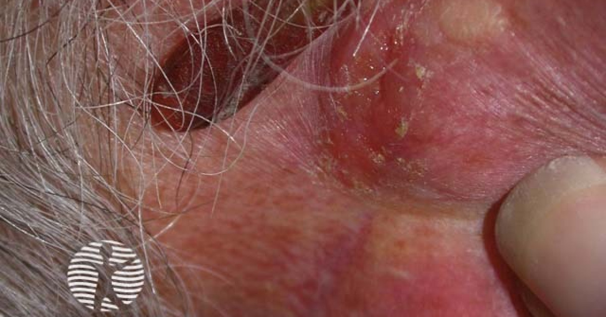 Intraepidermal carcinoma image